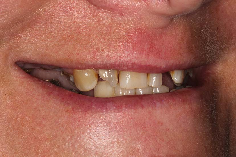 Teeth in a Day Jupiter FL - Palm Beach Gardens - West Palm Beach ...