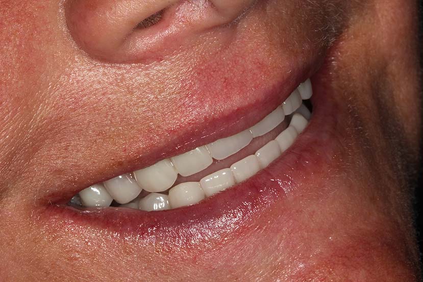 Teeth in a Day Jupiter FL - Palm Beach Gardens - West Palm Beach ...