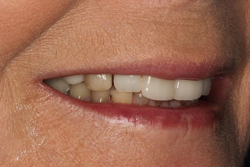 Teeth in a Day Jupiter FL - Palm Beach Gardens - West Palm Beach ...