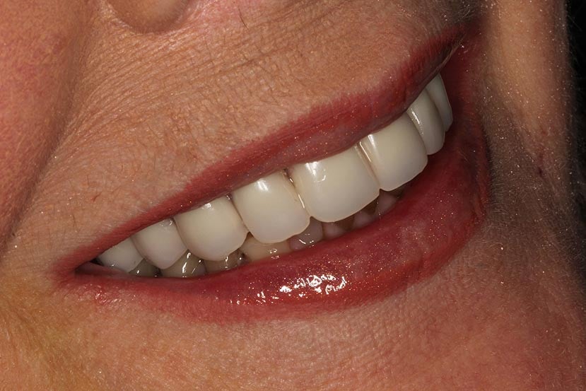 Teeth in a Day Jupiter FL - Palm Beach Gardens - West Palm Beach ...